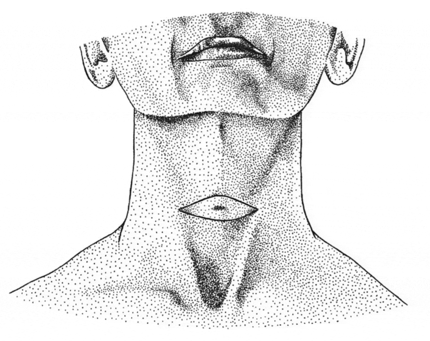 Wide anterior neck dissection for management of recurrent thyroglossal ...