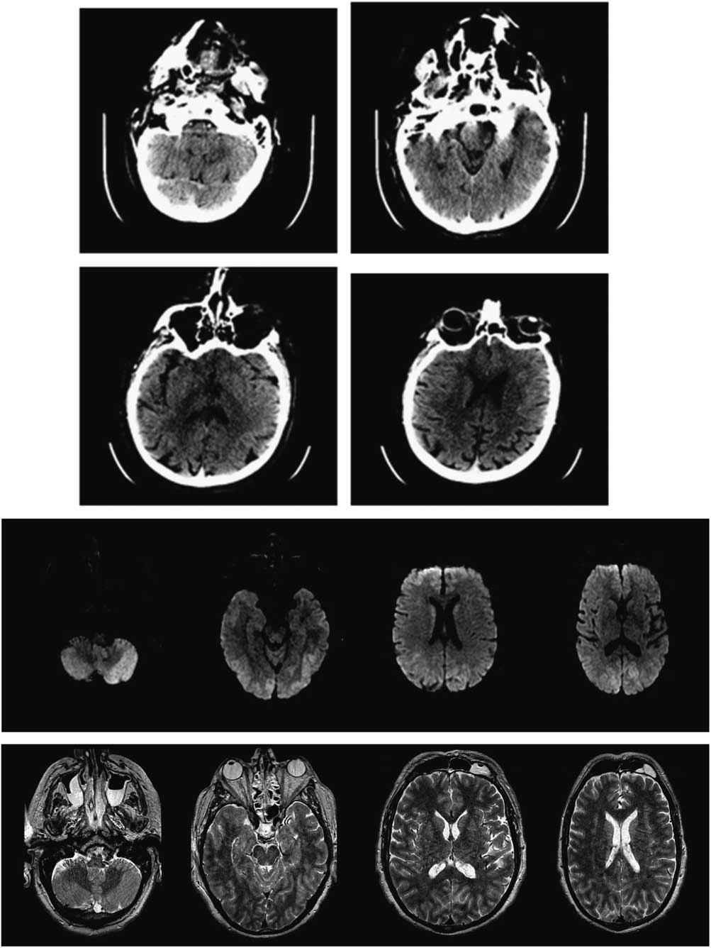Added Value of MRI over CT of the Brain in Intensive Care Unit Patients ...