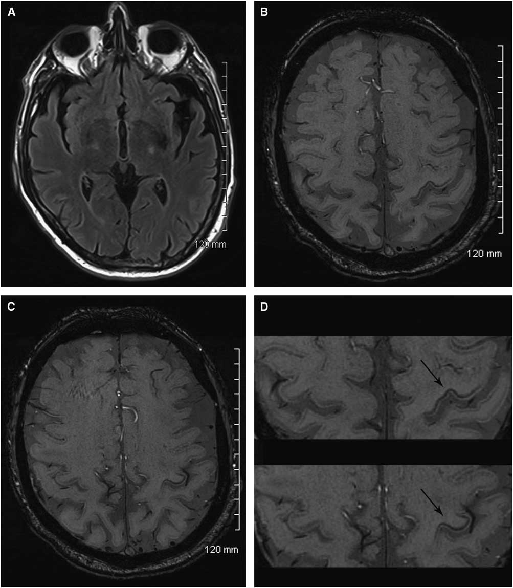 The “Motor Band Sign:” Susceptibility-Weighted Imaging in Amyotrophic ...