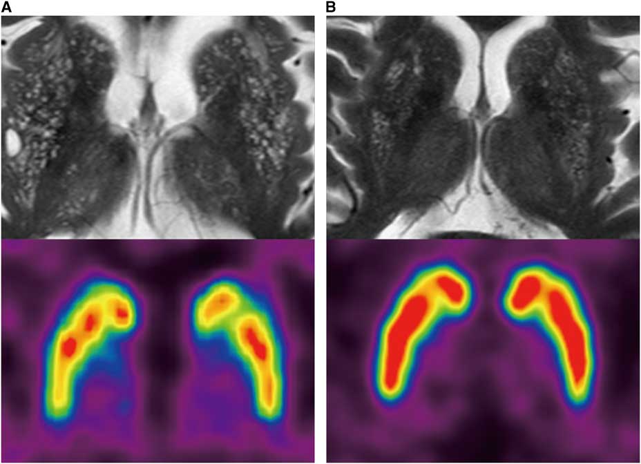 Dilated Virchow-Robin Space and Dopamine Transporter Imaging in the ...