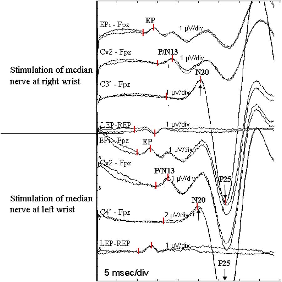 Giant Somatosensory Evoked Potentials Coincident With Epileptiform Discharges in Acutely ...