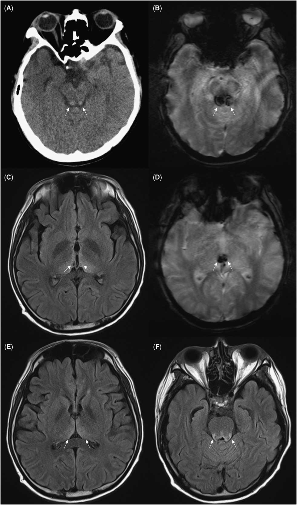 Bilateral Midbrain and Thalamic Hemorrhage in Wernicke Encephalopathy ...