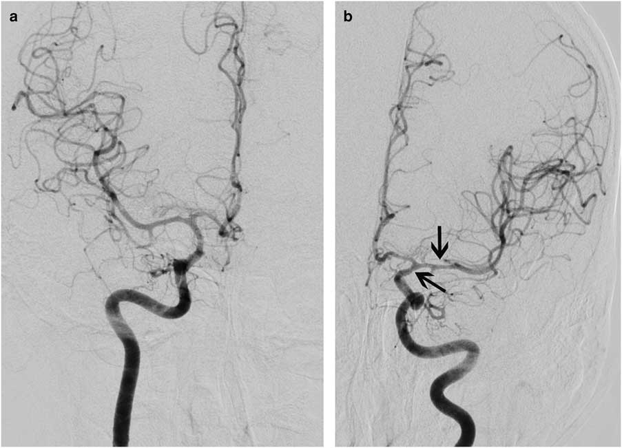Cerebral Vasospasm: A Review | Canadian Journal of Neurological ...