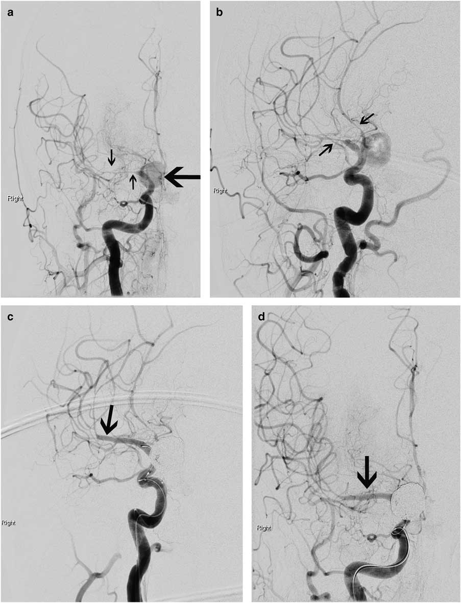 Cerebral Vasospasm: A Review | Canadian Journal of Neurological ...