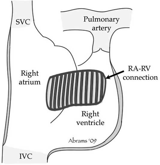 A novel and unique treatment of right ventricular inflow obstruction in ...