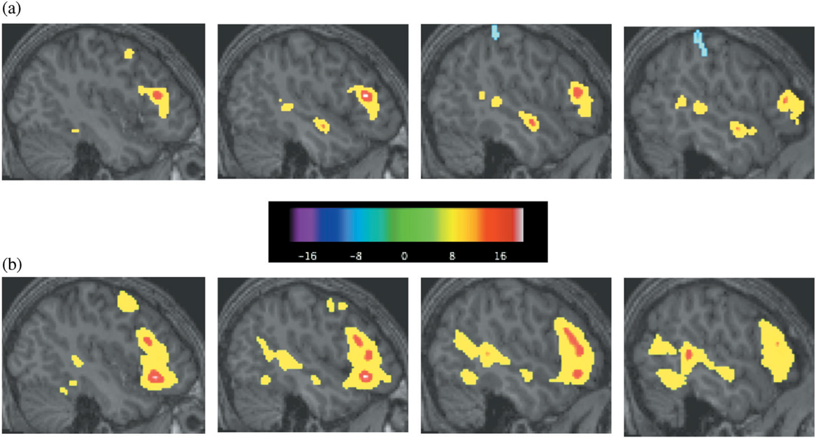 fMRI activation during a language task in adolescents with ASD ...