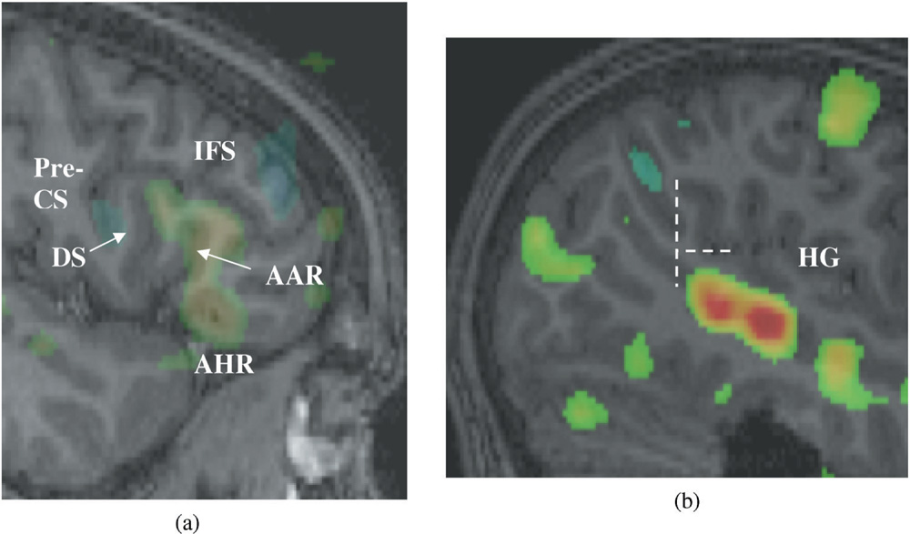 fMRI activation during a language task in adolescents with ASD ...