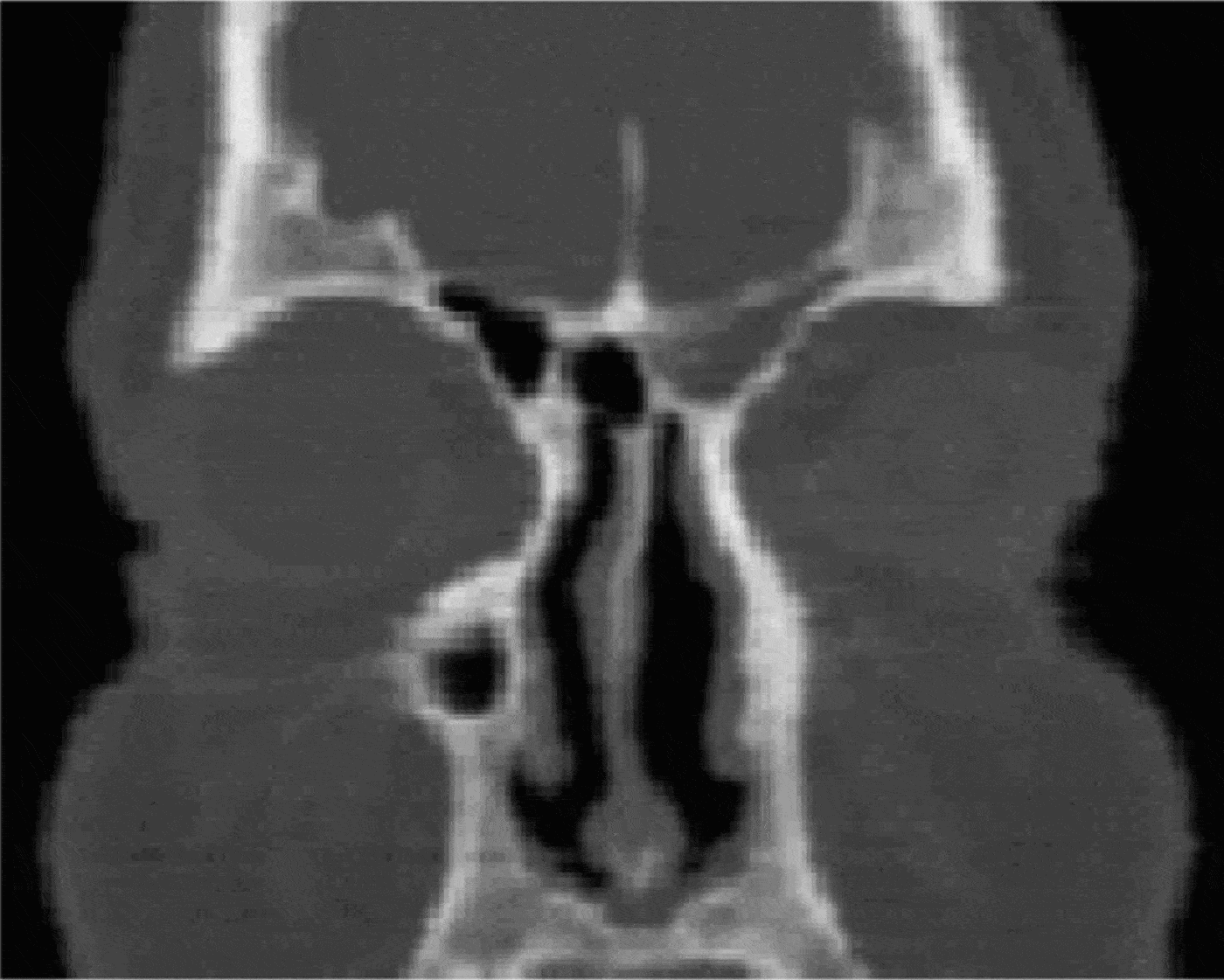Endoscopic modified Lothrop procedure for repair of lateral frontal ...