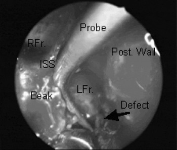 Endoscopic modified Lothrop procedure for repair of lateral frontal ...