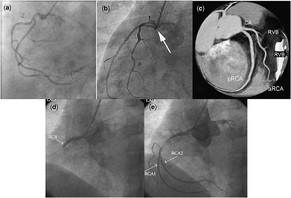 Double right coronary artery and its clinical implications | Cardiology ...