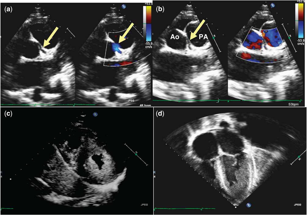 Anomalous left coronary artery from the right coronary cusp with gene positive apical ...