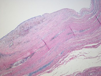 Anatomy-based surgery to remove thyroglossal duct cyst: two anomalous ...