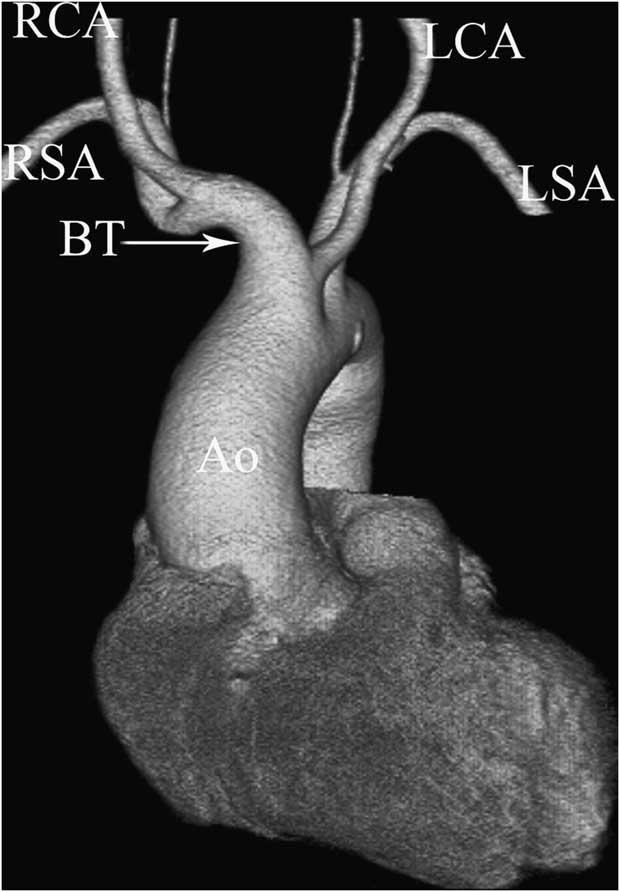 Anatomical variations of aortic arch branching: evaluation with ...
