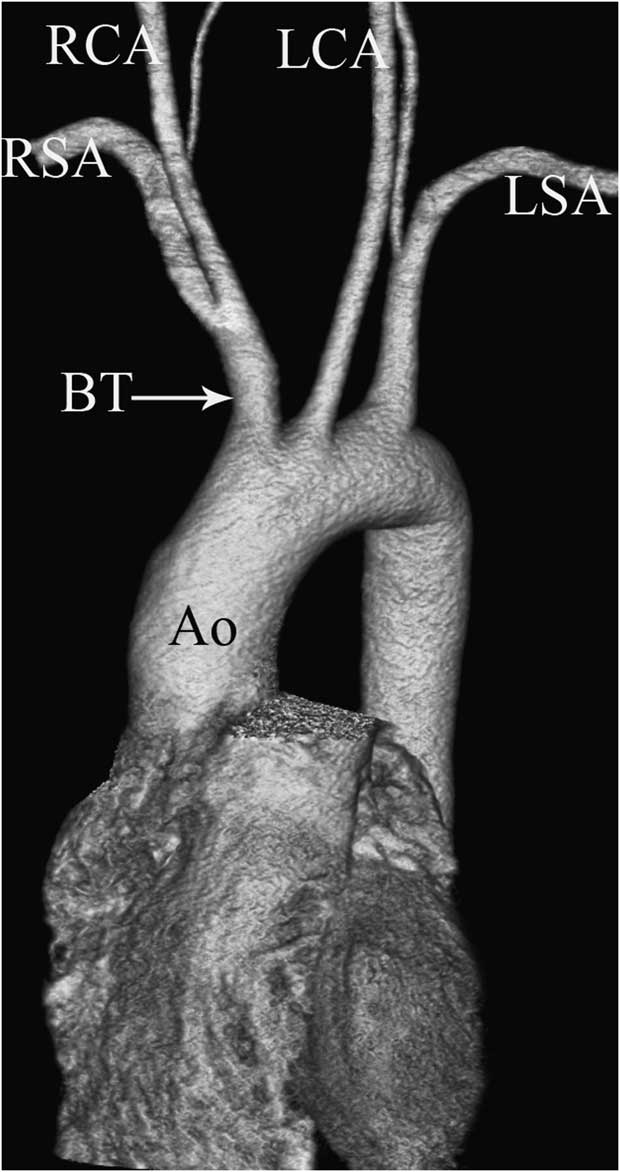 Anatomical variations of aortic arch branching: evaluation with ...