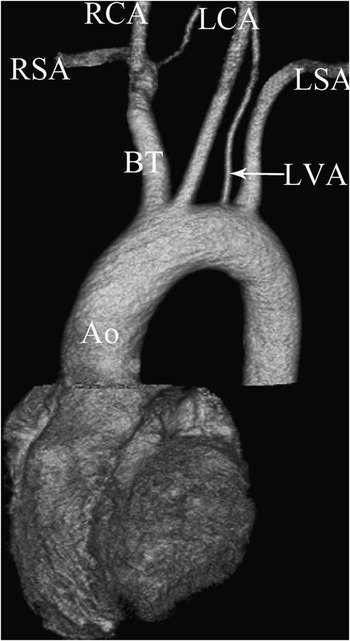 Anatomical variations of aortic arch branching: evaluation with ...