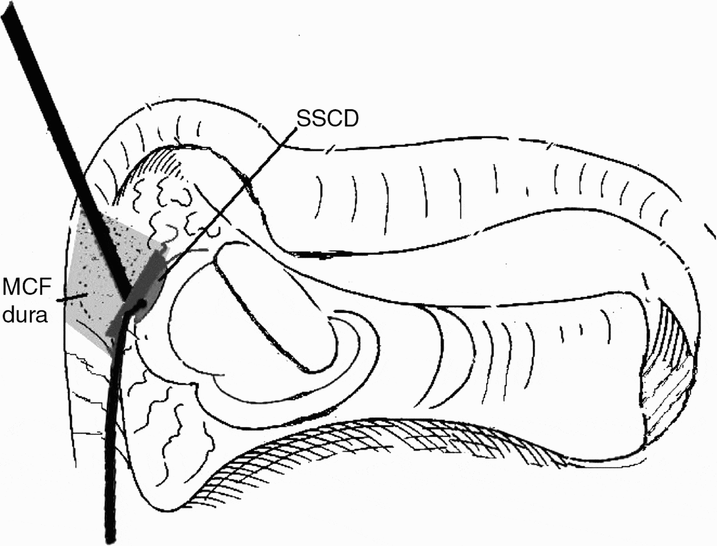 Transmastoid repair of superior semicircular canal dehiscence | The ...