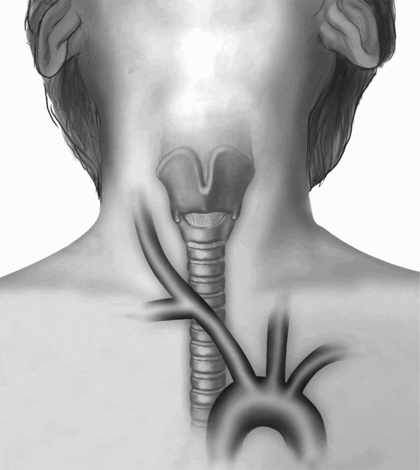 Protection of high-riding aberrant innominate artery during open ...
