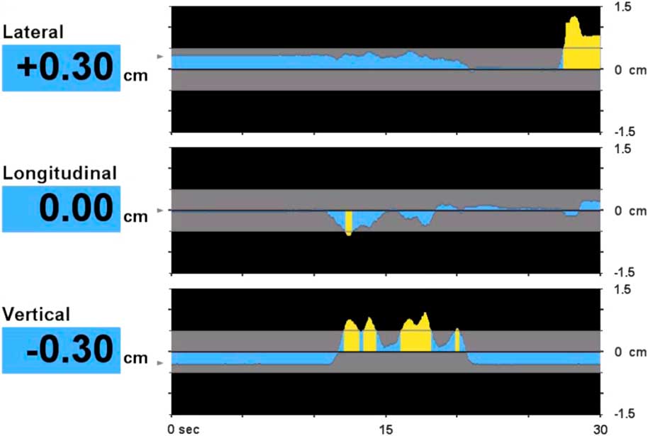 Calypso® 4D Localization System: a review | Journal of Radiotherapy in ...