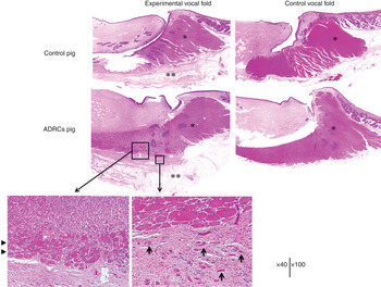 Autologous fat injection therapy including a high concentration of ...