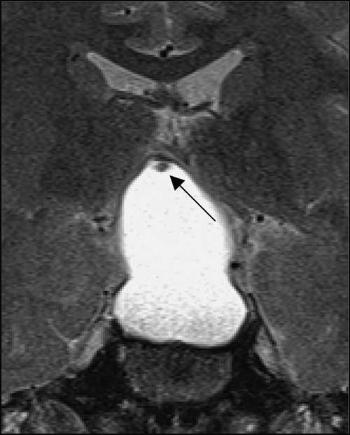 Intracystic Nodule in a Rathke’s Cleft Cyst | Canadian Journal of ...