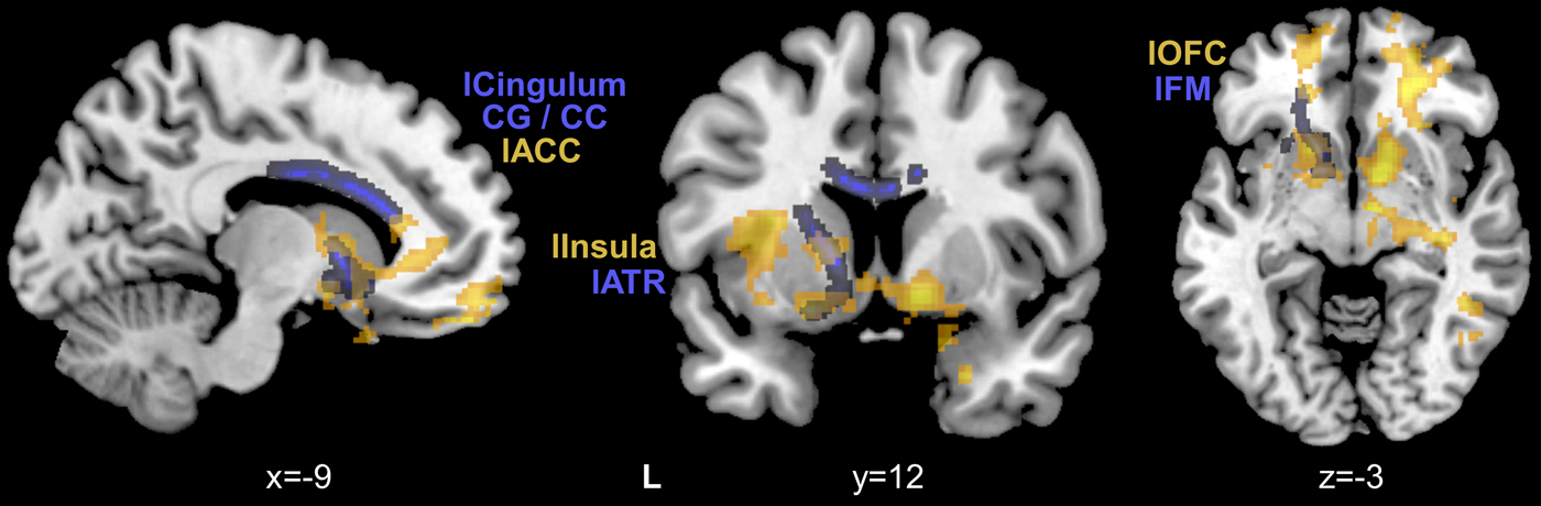 Disrupted salience network functional connectivity and white-matter ...
