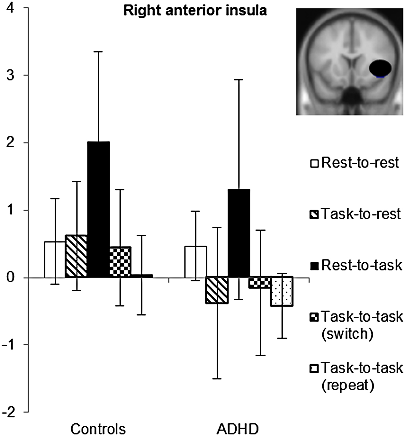 Default mode network abnormalities during state switching in attention ...