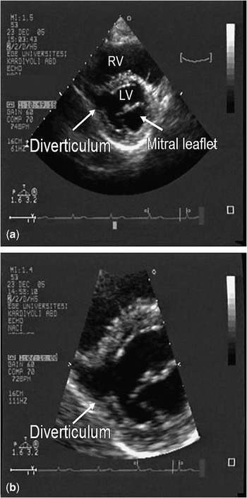 Congenital left ventricular diverticulum as a cause of chest pain in an ...