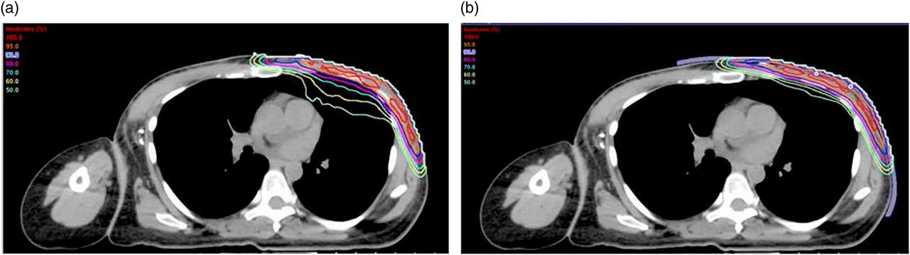 An alternative option to reduce lung dose for electron scar boost ...