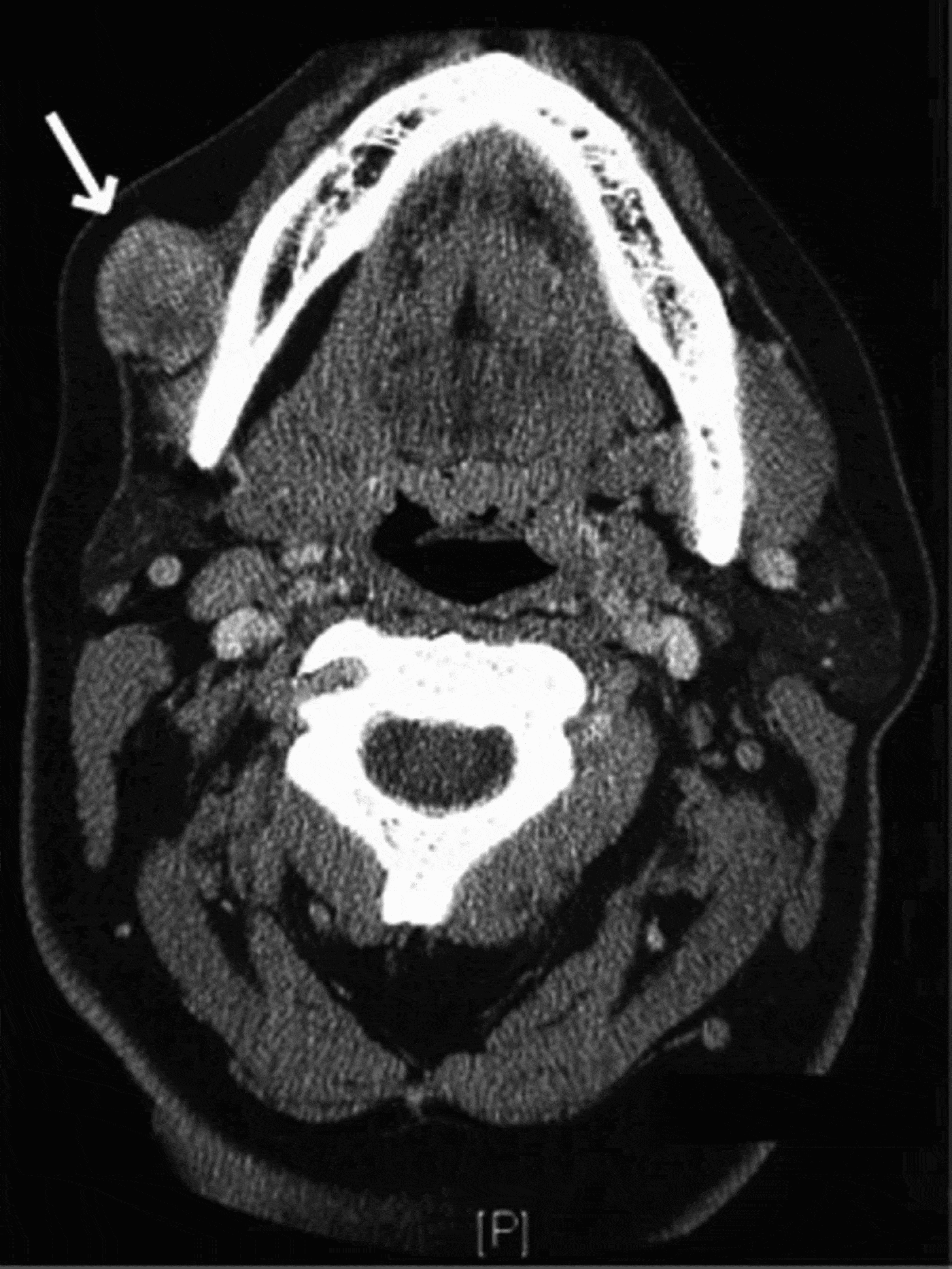 Nodular fasciitis: a case series | The Journal of Laryngology & Otology ...