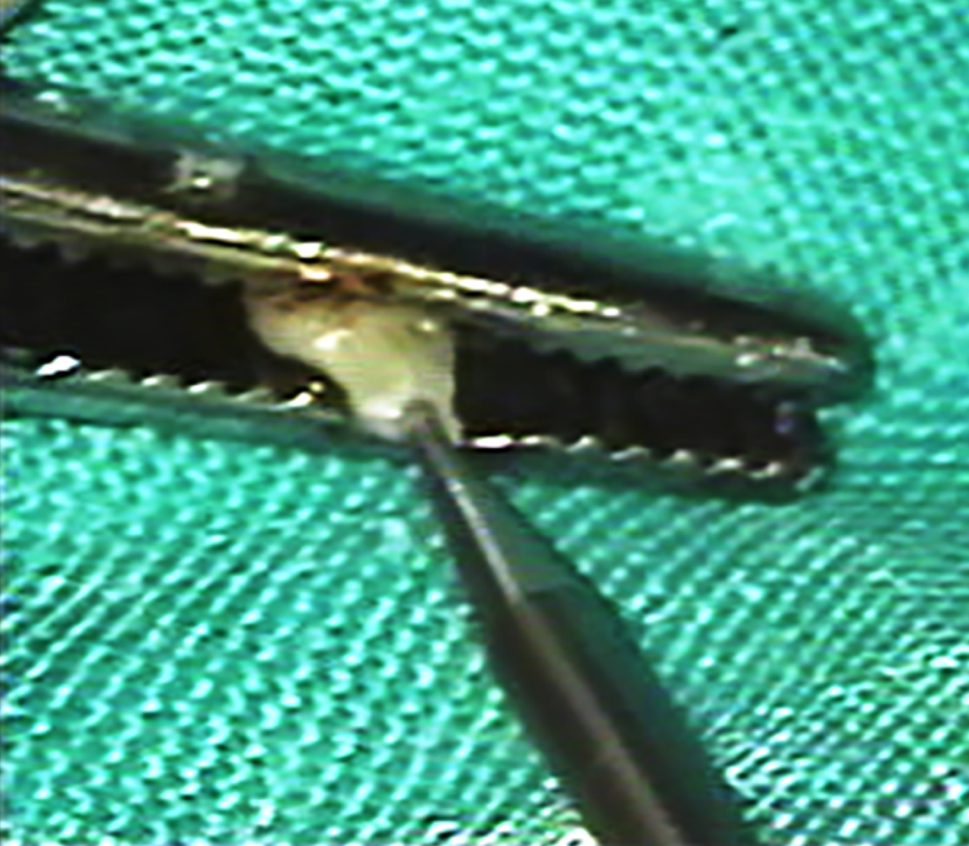 Autologous incus versus titanium partial ossicular replacement ...