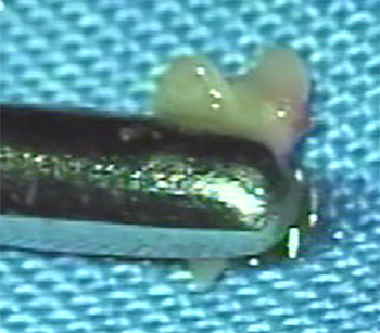 Autologous incus versus titanium partial ossicular replacement ...