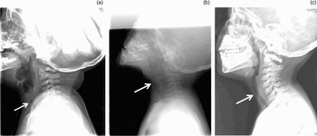 Anterior cricoid split procedure with transposition of cricoid ...