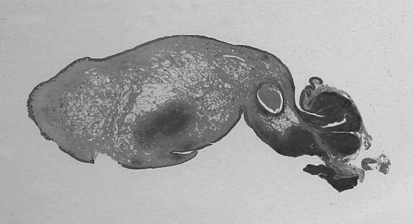 Fibroepithelial polyp of the tonsil: case report of a rare, benign ...
