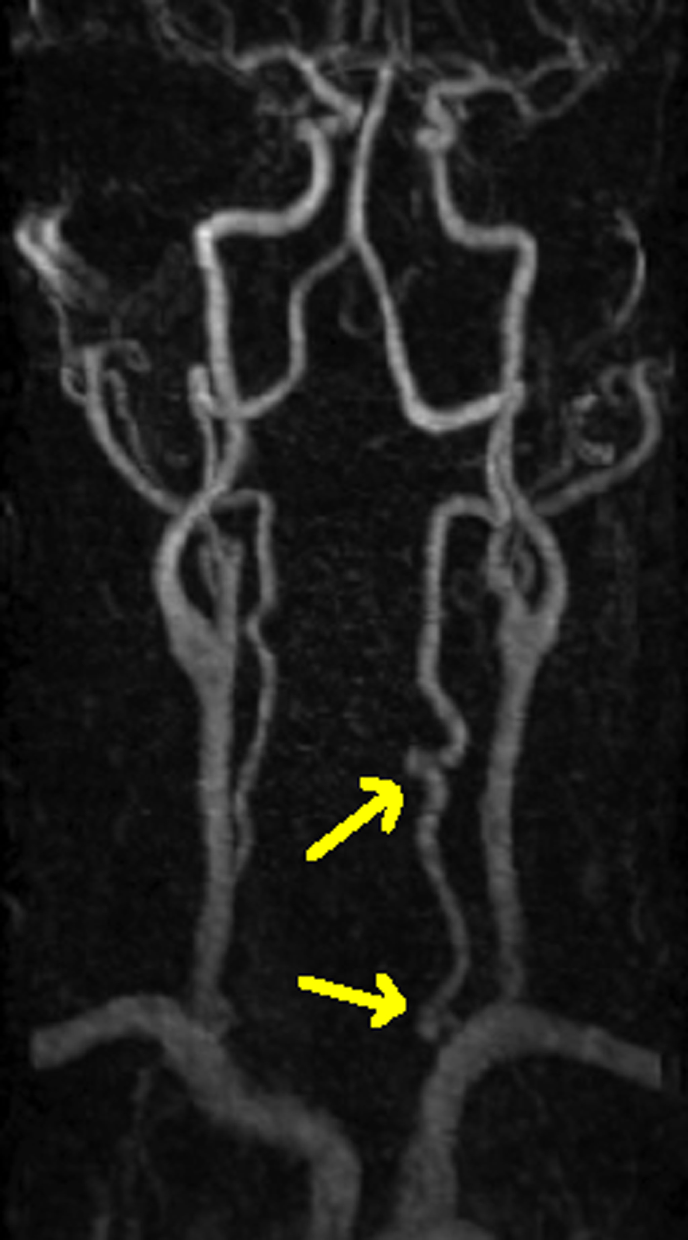 Classification of vertebral artery loop formation and association with ...