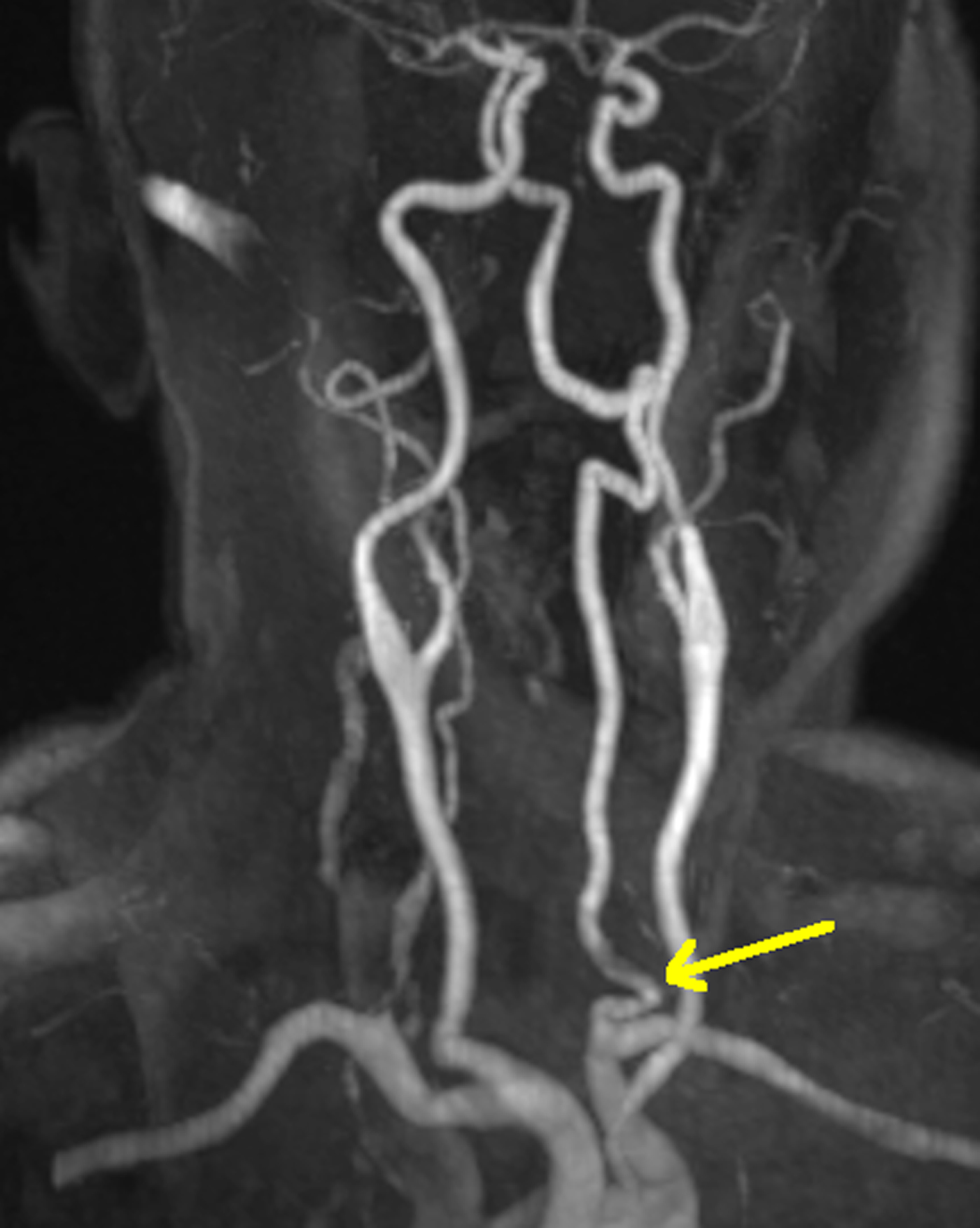 Classification of vertebral artery loop formation and association with ...