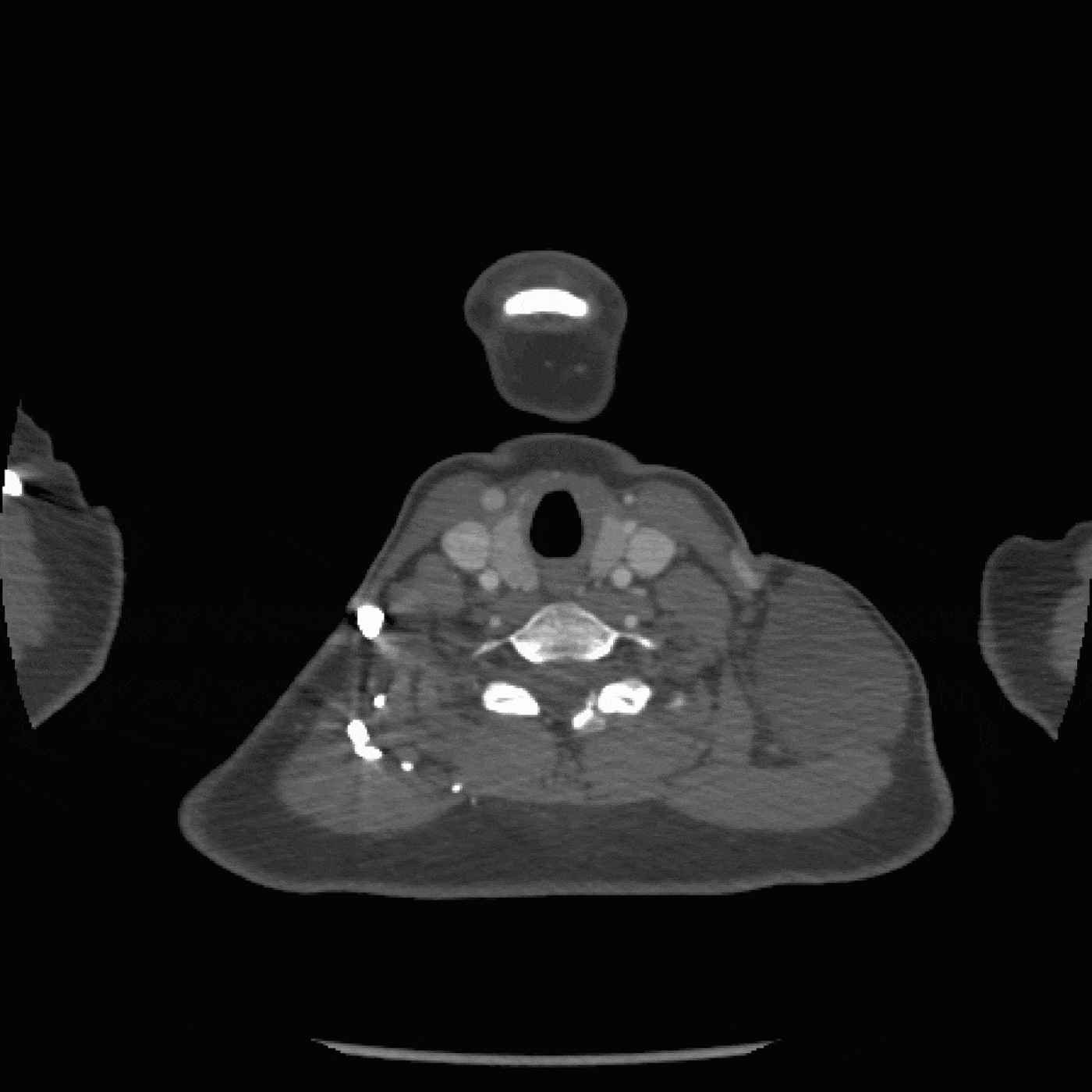 Adult cystic hygroma: successful use of OK-432 (Picibanil®) | The ...