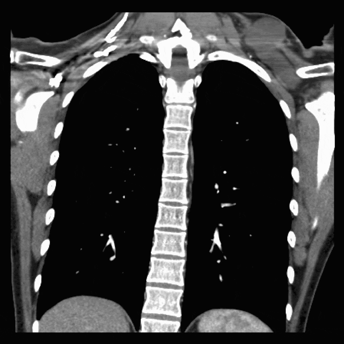 Adult cystic hygroma: successful use of OK-432 (Picibanil®) | The ...