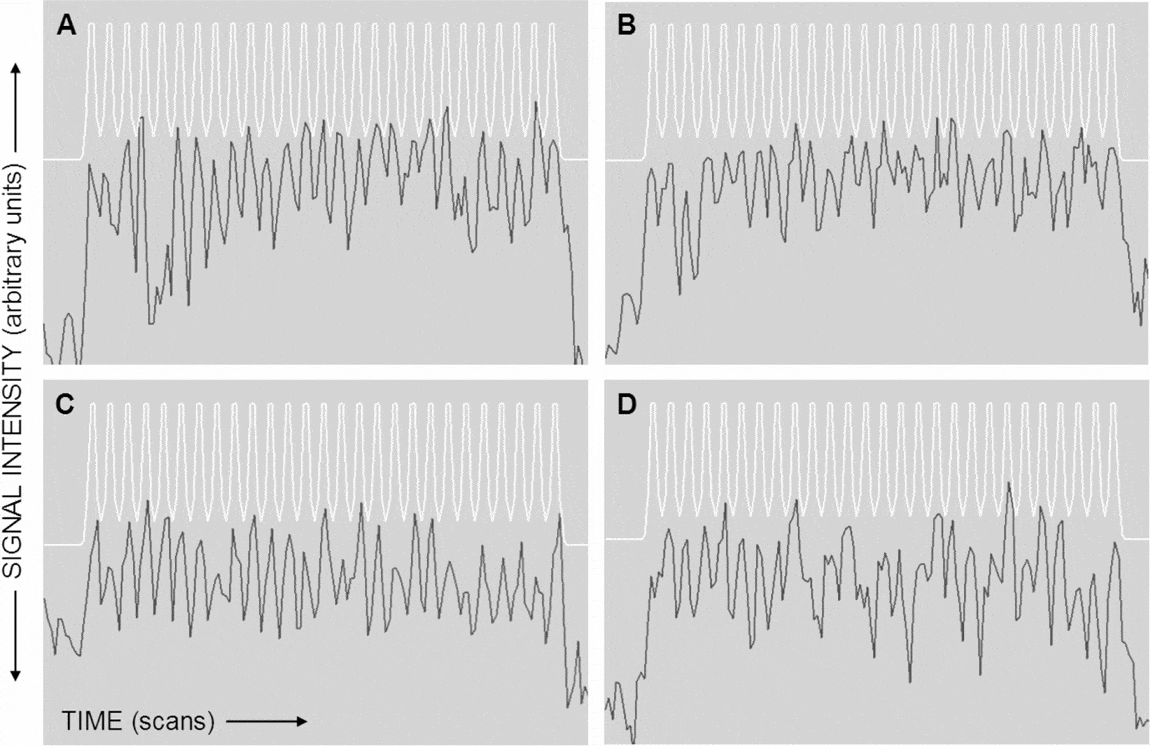 Functional MRI neuroanatomic correlates of the Hooper Visual ...