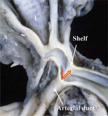 Hypoplasia of the left heart | Cardiology in the Young | Cambridge Core