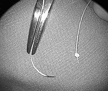 Quilting sutures for nasal septum | The Journal of Laryngology ...