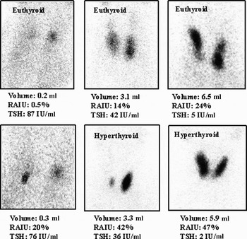 Determination of remnant thyroid volume: comparison of ultrasonography ...
