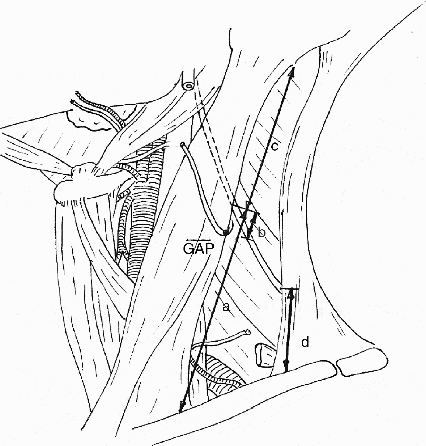 Accessory nerve: anatomy and surgical identification | The Journal of ...