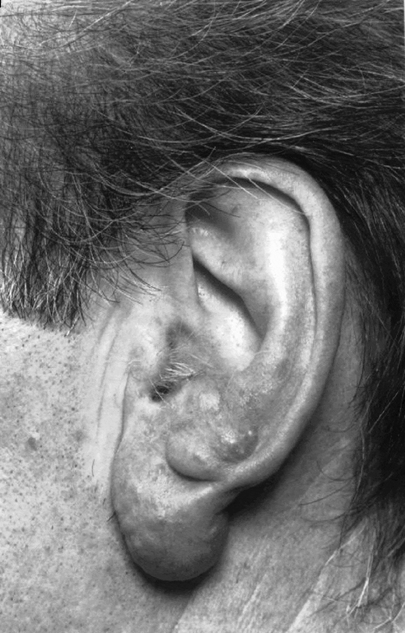 Primary B-cell lymphoma presenting as bilateral ear lobule swelling ...