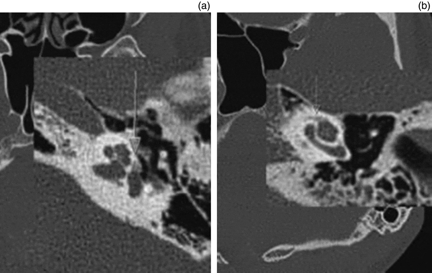 Importance of a dedicated neuroradiologist in reporting high-resolution ...