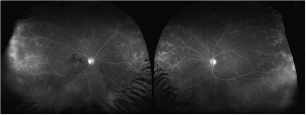 Uveitis and the Diagnosis of Multiple Sclerosis | Canadian Journal of ...