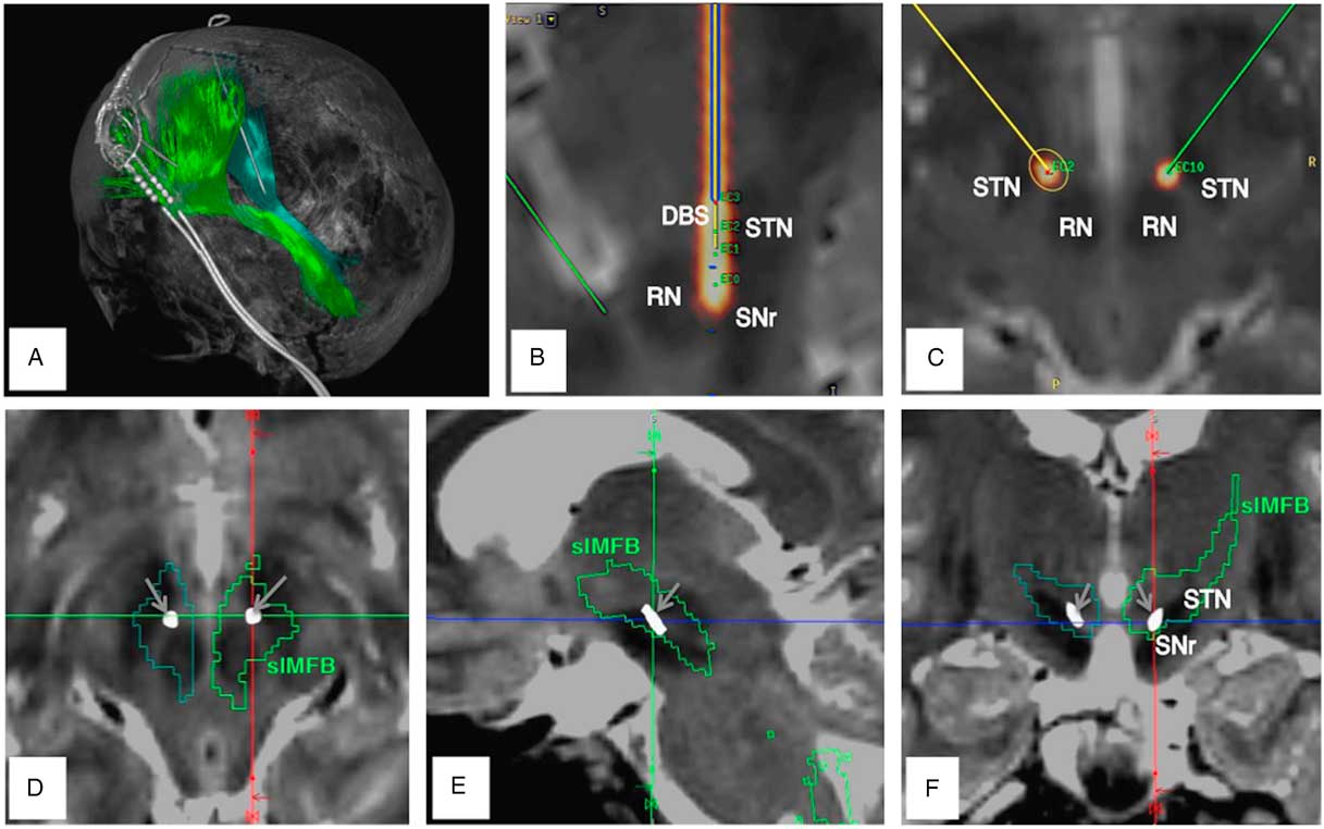 The medial forebrain bundle as a target for deep brain stimulation for ...