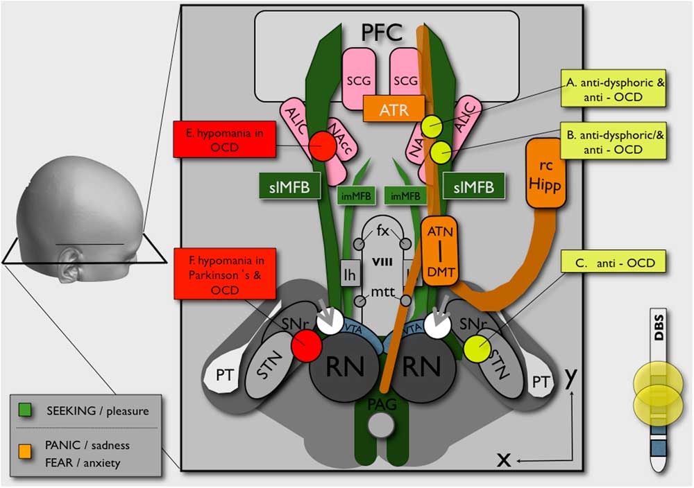 The medial forebrain bundle as a target for deep brain stimulation for ...