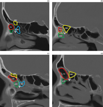 Influence of opacification in the frontal recess on frontal sinusitis ...