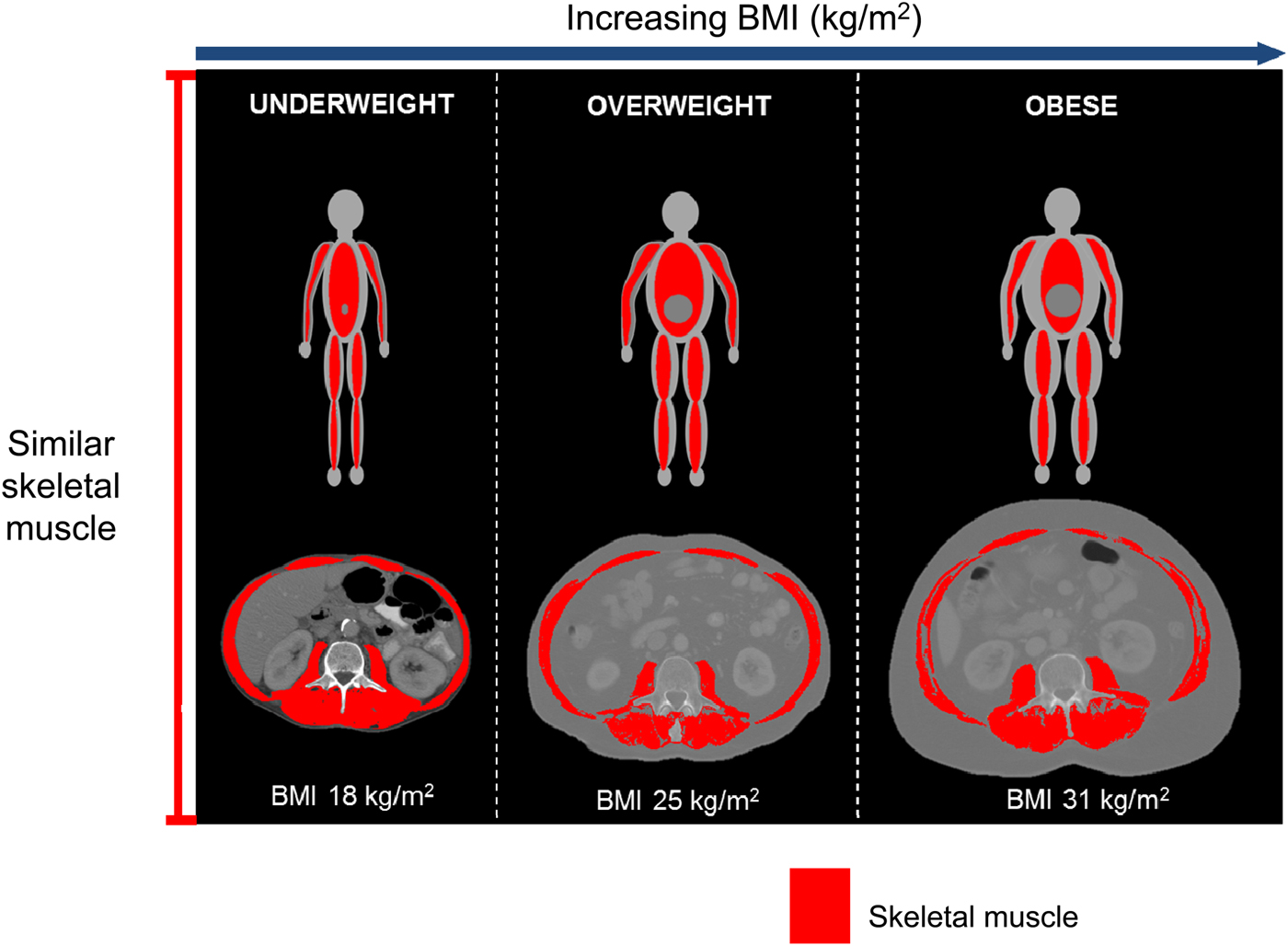 Sarcopenia and cachexia in the era of obesity: clinical and nutritional ...