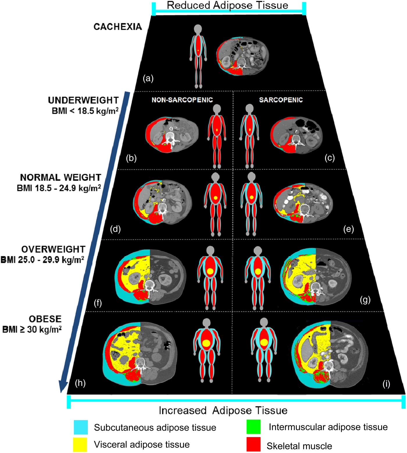 Sarcopenia and cachexia in the era of obesity: clinical and nutritional ...